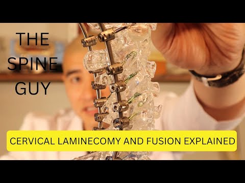 Cervical Laminectomy and Fusion Explained