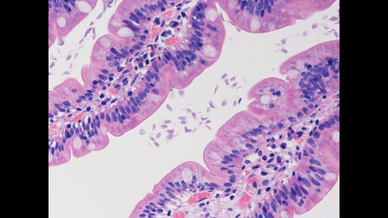 Giardiasis - Pathology mini tutorial