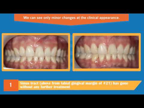 Palatal Root Torque Control With Orthodontic Braces - Video By BFC Dental Clinic, Thailand