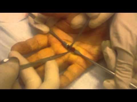 Trigger Finger Release In-office