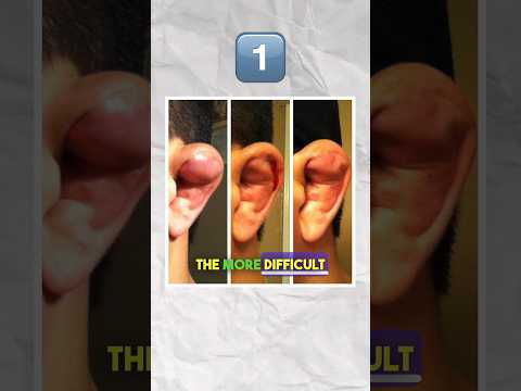 What To Do If You Have Cauliflower Ear 👂 #ufctraining #mmatraining #ufcnews #mmanews