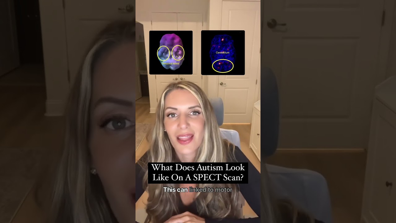 What Autism Looks Like In The Brain Using Brain SPECT Imaging
