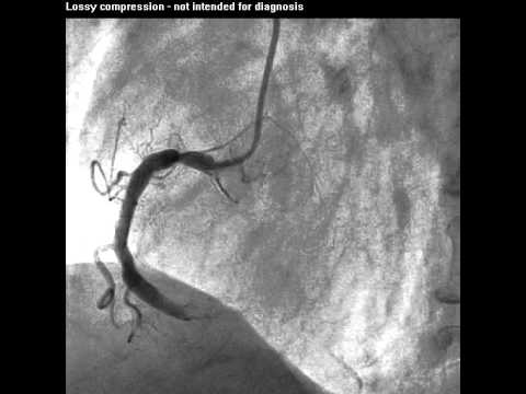 RCA 100% stenosis - Angio 1