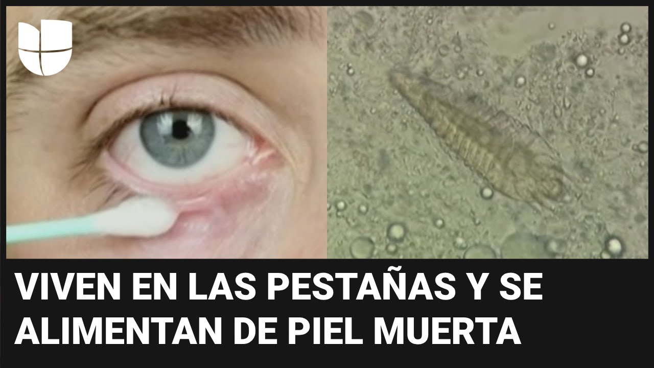 How can you tell if you have mites on your eyelashes? We explain the symptoms.