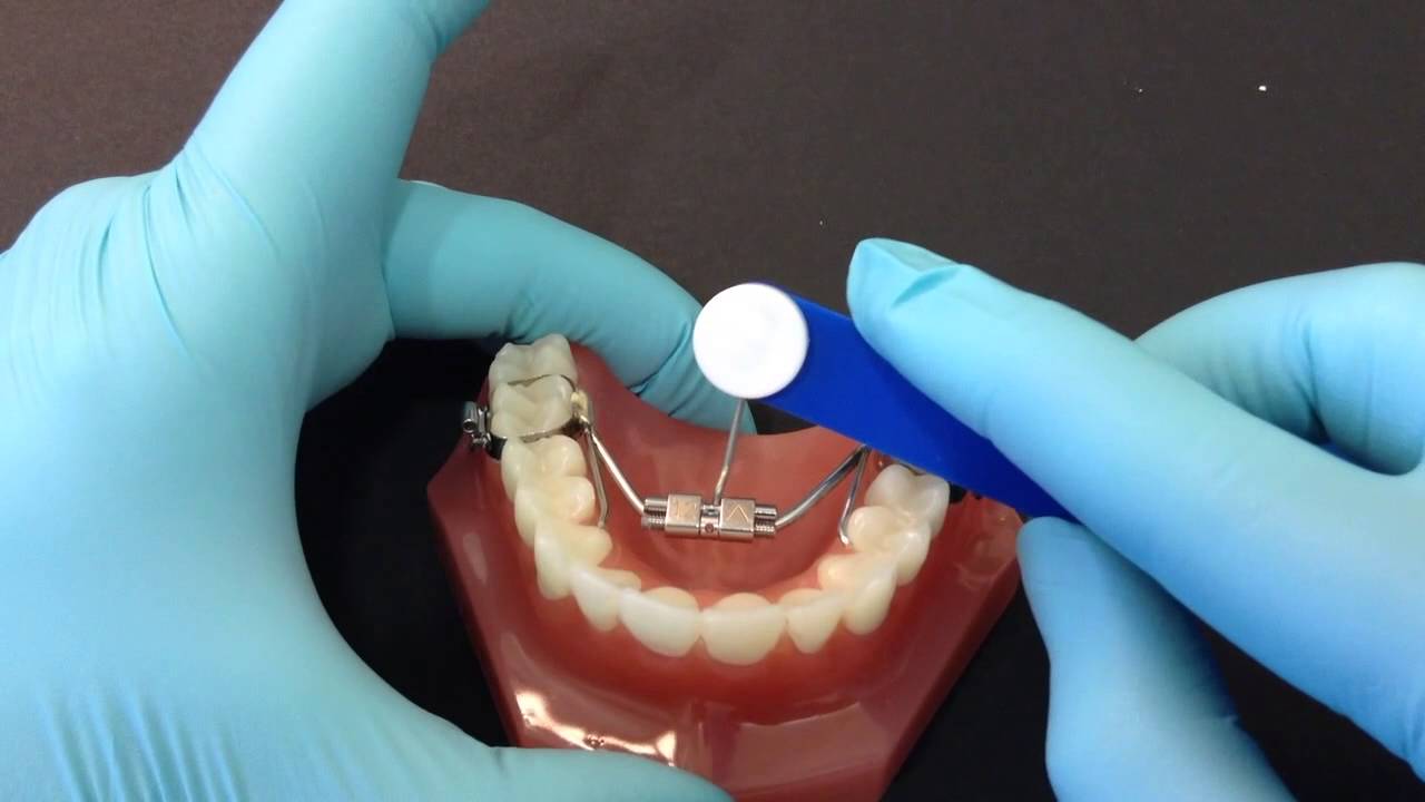 Palatal Expander Activation