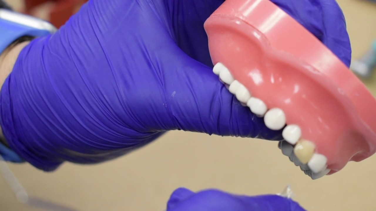 Anterior Strip Crown