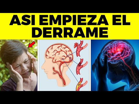 Así Empieza El Derrame Cerebral En Una Mujer - Signos Y Síntomas de Derrame Que Debes Conocer
