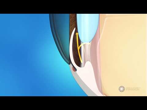 What is angle-closure glaucoma?