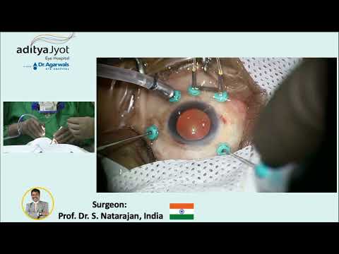 Cairo Retina Meeting - Live Retina Surgery by Prof Dr S Natarajan 2023 #egypt #retinasurgery
