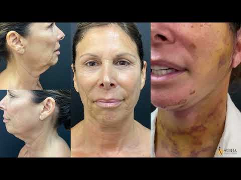Lower Face & Neck Lift patient journey  @suriaplasticsurgery  |Dr. Shashi Kusuma