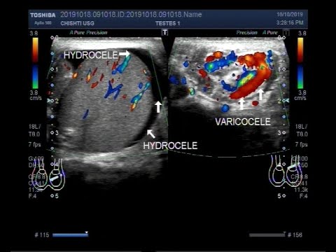Ultrasound Video showing Hydrocele and a varicocele of testis.