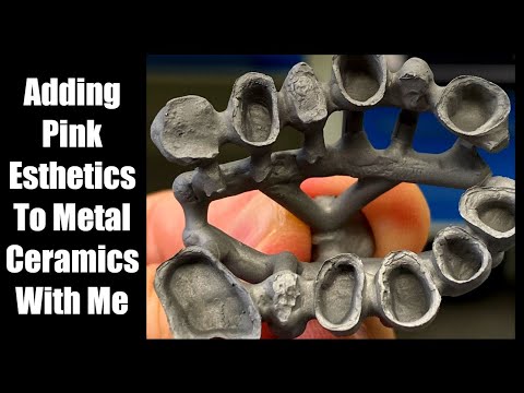Add Pink Esthetics to Metal Ceramics With Me