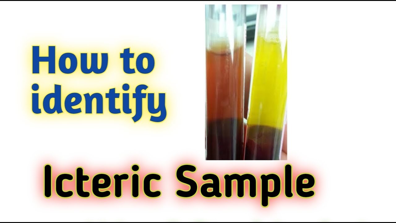 How to identify ictreic sample | icteric serum