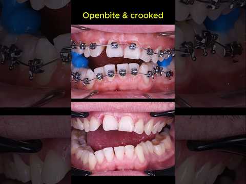 Braces for openbite and crooked teeth #braces #dentist #orthodontist