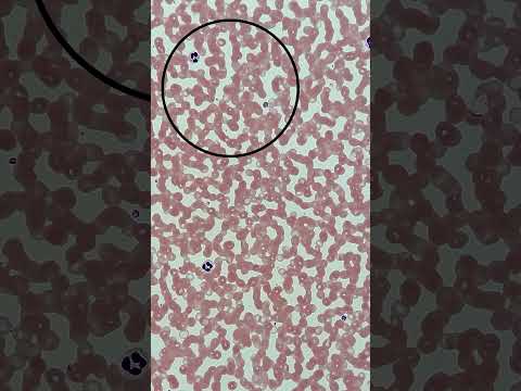 Malaria under the microscope 🩸🔬