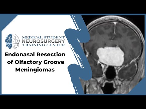 Endonasal Resection of Olfactory Groove Meningiomas