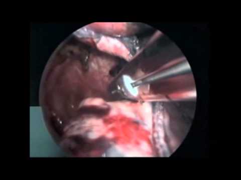 Thoracoscopic (VATS) Surgery for Pneumothorax
