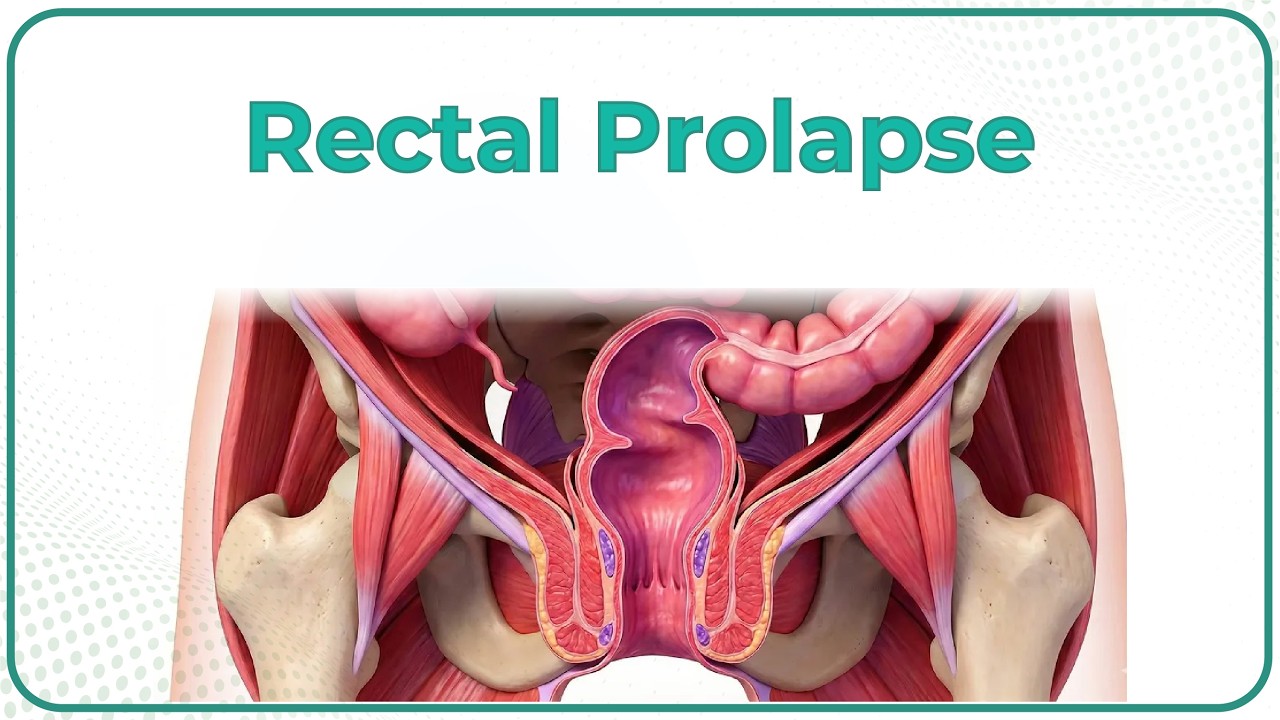 Rectal Prolapse: Introduction, Clinical features, Diagnosis, Management: Surgery