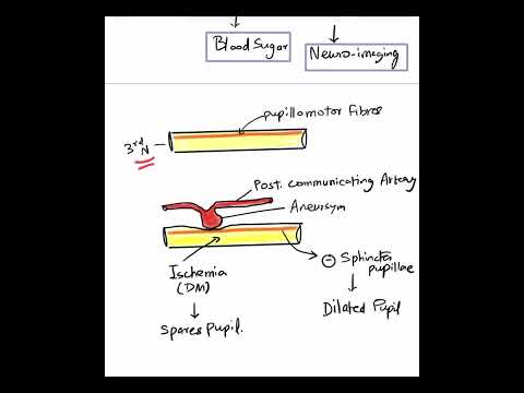 3rd Nerve Palsy - Pupil sparing vs. Pupil involving #Mustknow #Shorts