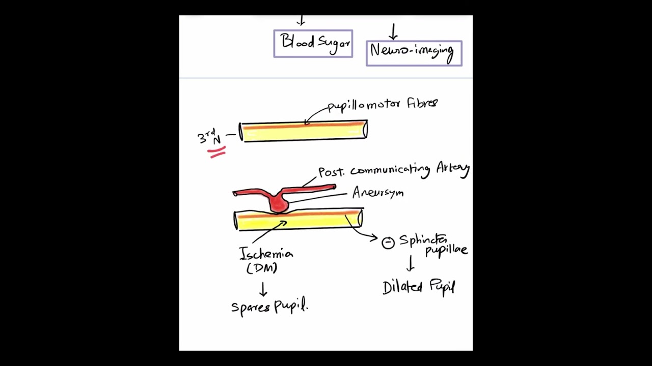 3rd Nerve Palsy  - Pupil sparing vs. Pupil involving #Mustknow #Shorts