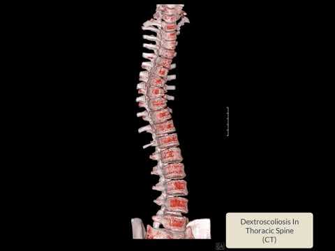 Dextroscoliosis In Thoracic Spine