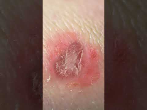 புற்று நோய் ஆரம்ப அறிகுறிகள் எப்படி இருக்கும்? | Common Symptoms of Cancer | Dr John Grifson