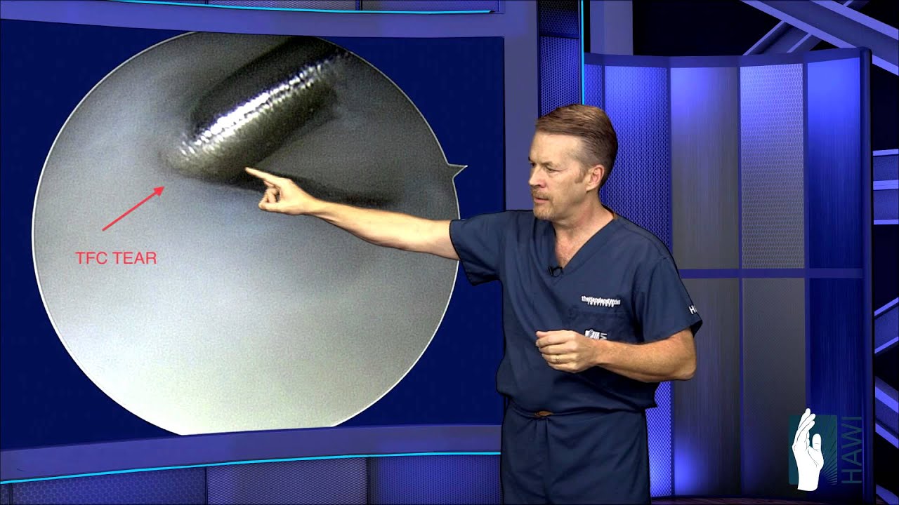 TFC Surgery (Triangular Fibrocartilage Complex)