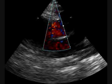 Echocardiogram in perimembranous ventricular septal defect – Chicago's ...