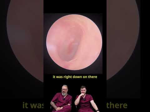 40 Years Without Wax Removal Leads to Major Hearing Issues!