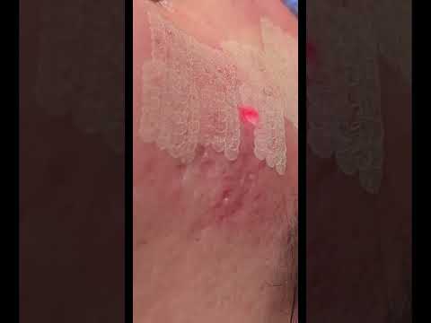 Acne Scar Laser #shorts #shortvideo