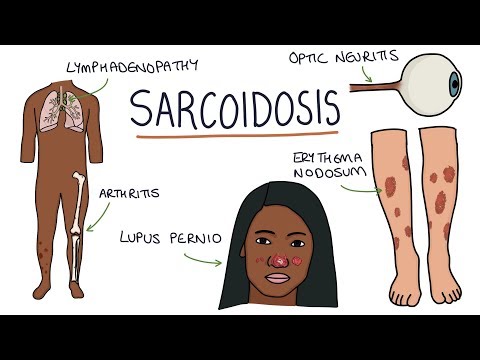 Understanding Sarcoidosis: A Visual Guide for Students