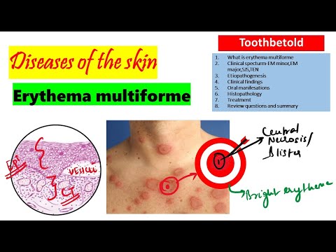 Erythema Multiforme - Etiology, Clinical features, Histopathology, treatment