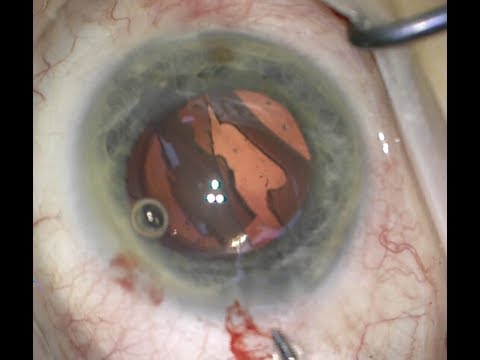 Opacified Oculentis IOL Removal and Replacement