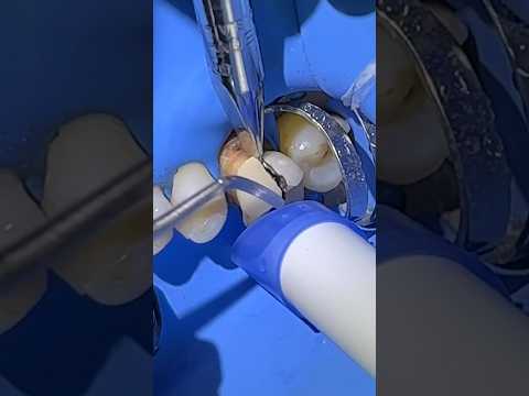 When patients ask if a crown can be biomimetic...✨ #shorts #dentalcrowns #dentist