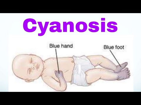 Cyanosis definition, and some pictures