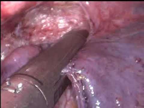 THORACOSCOPIC STAPLED BULLECTOMY FOR SPONTANEOUS PNEUMOTHORAX