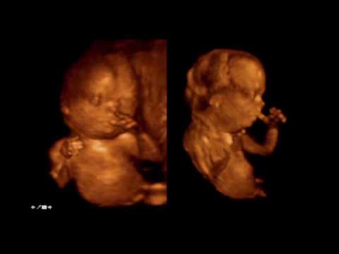 An Approach to Fetal Syndromes