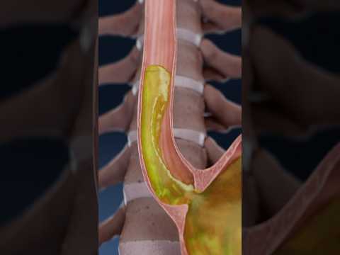 Acid Reflux, GERD, and Heartburn explained in 3D