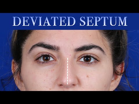 How To Fix A Deviated Septum | Dr Moustafa Mourad | Mourad NYC