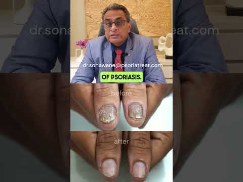 Effective Homeopathic Treatment for Nail Psoriasis | Before & After Results
