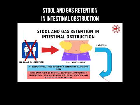 Stool and gas retention in intestinal obstruction #stool #bloating #intestinalobstruction #intestine