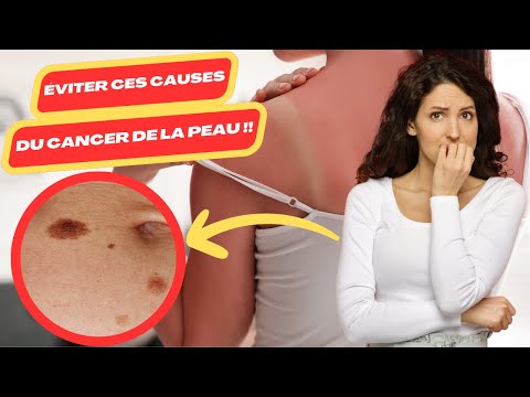 Éviter ces 5 causes du cancer de la peau !! cancer de la peau photo | cancer de la peau melanome