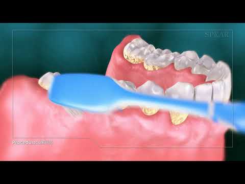 Gingivitis