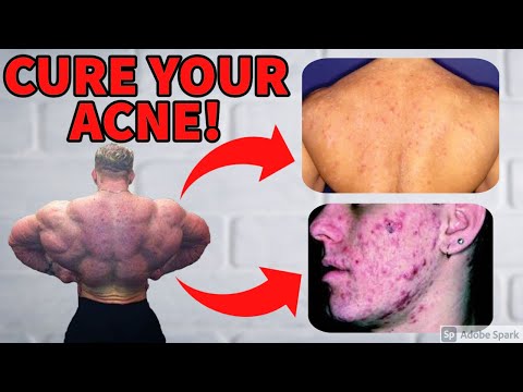Cure Your Acne / Bacne | Steroid Acne | Doctor’s Analysis | Trenbolone ...