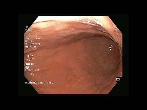 Upper GI endoscopy| Esophagogastroduodenoscopy| Gastritis| Duodenal ulcer| Hiatus hernia| Stomach