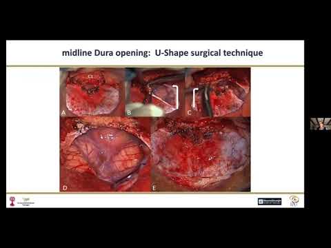 Brainstem tumors in children