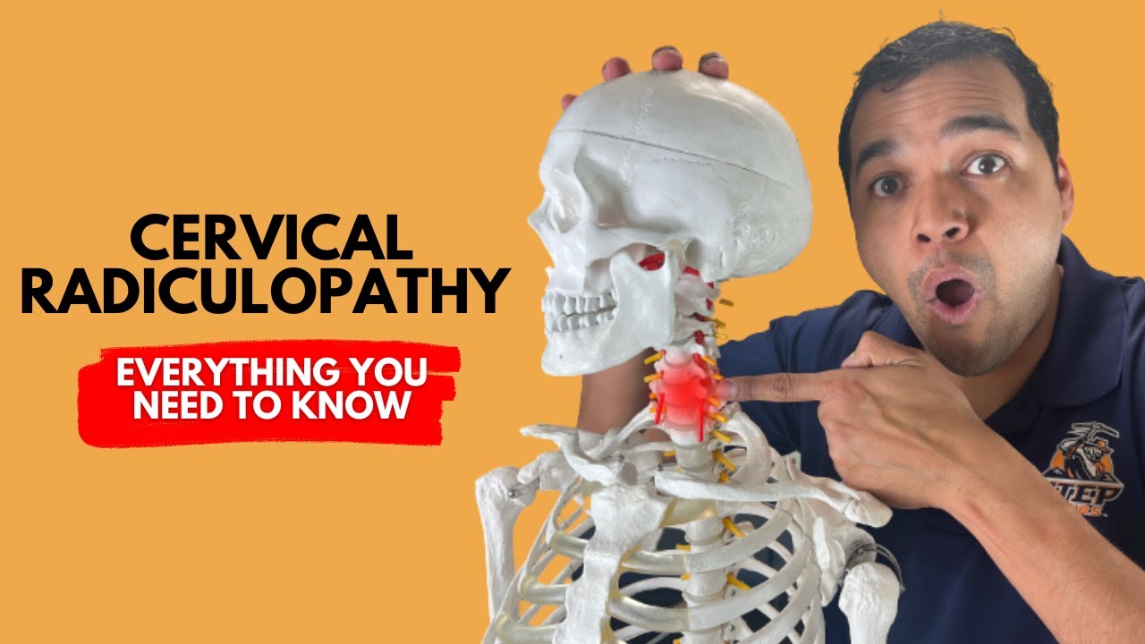 Cervical Radiculopathy: Everything You Need To Know To Get Better Without Surgery