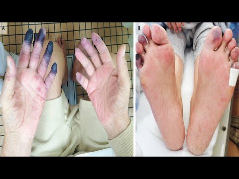 American Sign Language ASL Video Dictionary - sphacelus