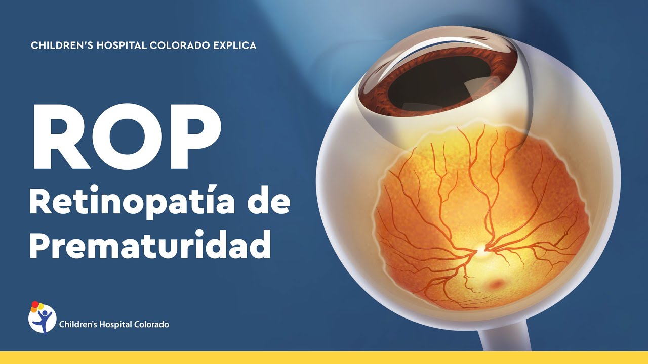 Retinopatía de la prematuridad: diagnóstico y tratamiento