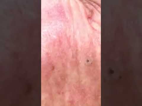 Some video-worthy blackheads on the face, wouldn't you say?